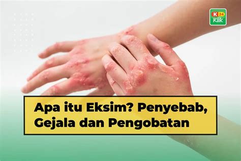 Apa Itu Eksim Penyebab Gejala Dan Pengobatan K24Klik