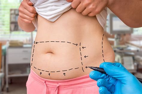 Cicatriz da abdominoplastia quais os cuidados necessários Servimedic