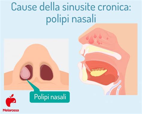 Sinusite cos è sintomi rimedi e come si cura