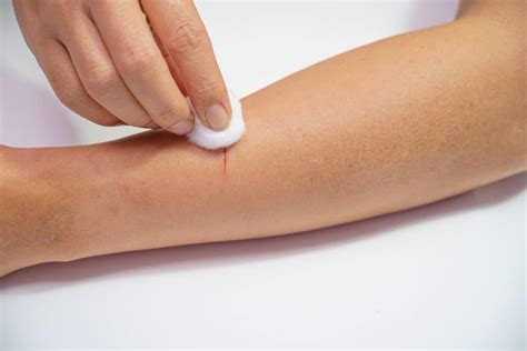 Água oxigenada para tratar feridas é correto usar CliqueFarma