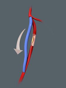 Surgical Bypass Sydney Bypass Surgery Angioplasty Sydney