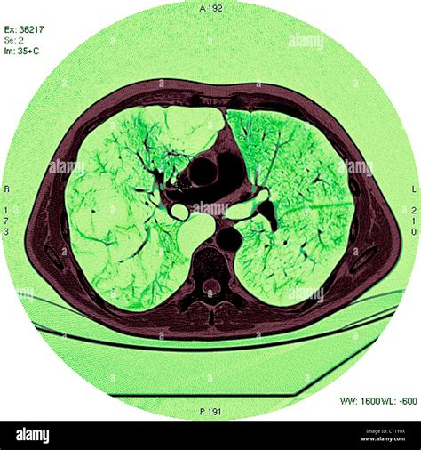 LUNG SCAN FOR EMPHYSEMA Stock Photo Alamy