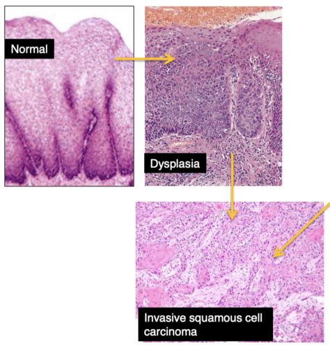 Pathology Of GI Cancers Flashcards Quizlet