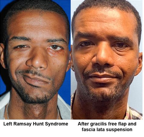 Ramsay Hunt Syndrome UNC Facial Nerve Center