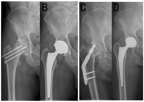 J Orthop Surg Res全髋关节置换术治疗股骨颈骨折内固定失败345例2 14年的回顾性研究 MedSci cn