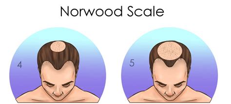 5000 Grafts Hair Transplant Operation And Cost Heva Clinic