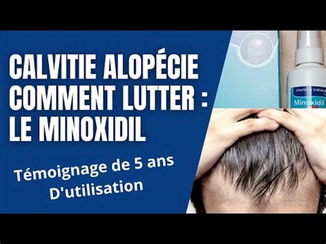 Le Minoxidil Est Ce Efficace Youtube