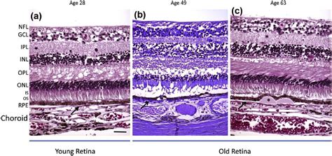 Scaffolds For Retinal Pigment Epithelial Cell Transplantation In Age