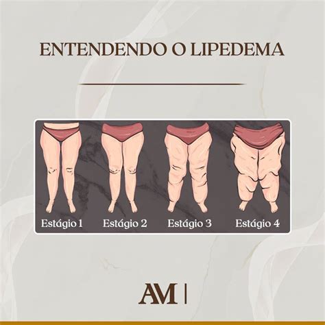1 Entendendo o Lipedema Dr André Mattos