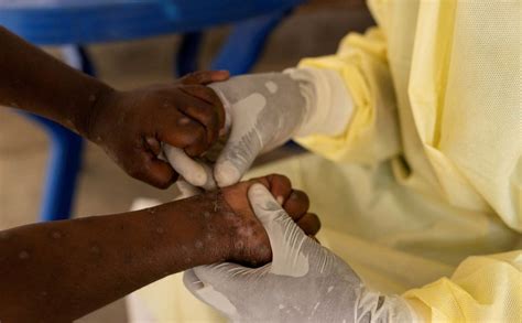 Tailândia confirma primeiro caso de nova variante da mpox