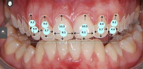 Dientes detrás de otros Caso clínico con carillas estéticas