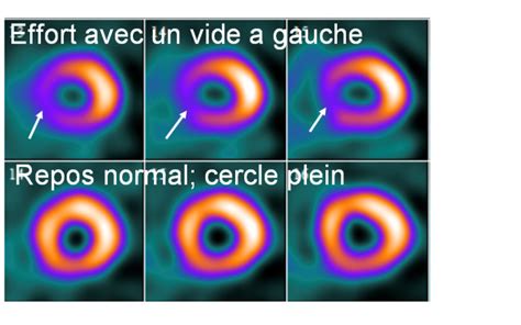 Scintigraphie myocardique ou MIBI à leffort Icardio