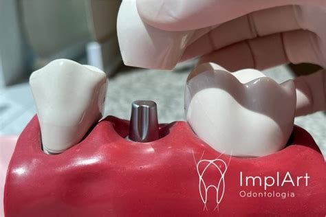 implante dentario como é a cirurgia ImplArt
