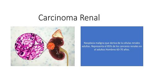 Carcinoma Renal Andy Udocz