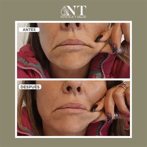 Rejuvenecimiento facial Antes y después Esteticas ar Esteticas