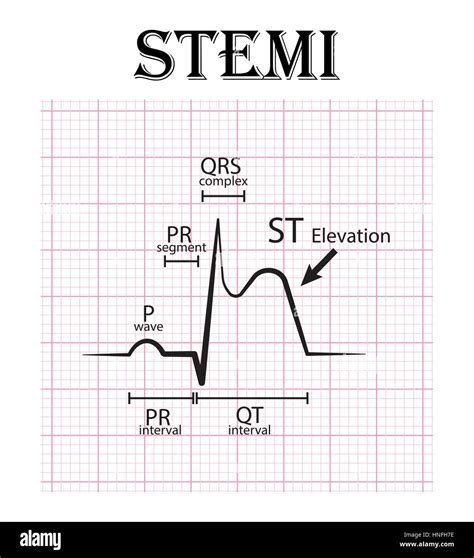 ECG de infarto de miocardio con elevación del ST STEMI y detalle de