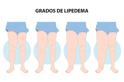 Grados De Lipedema Conoce Todos Los Tipos Dra Yag Es