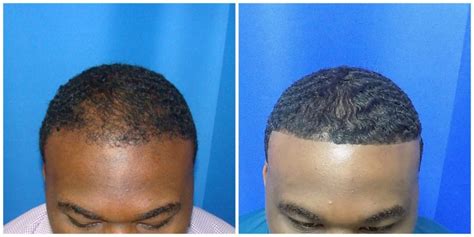 Patient Neograft Before And After Photos Houston Tx Plastic
