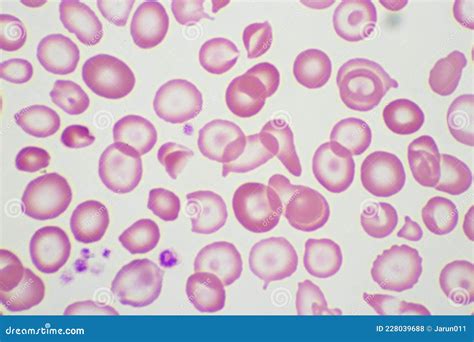 Target Cells With Abnormal Red Blood Cells In Blood Smear Stock Photo