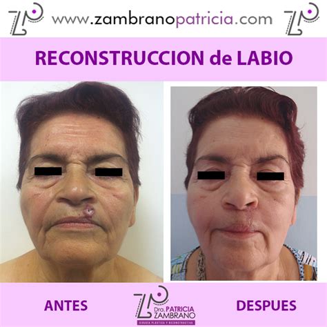 Sintético 92 Foto Como Detectar Cáncer De Piel Fotos Lleno