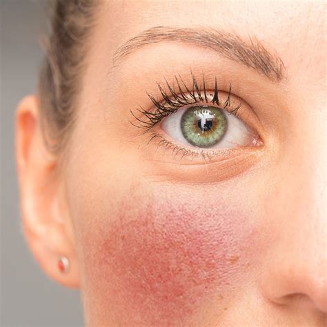 Laser Resurfacing Side Effects Risks Ultimate Guide