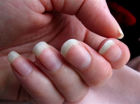 Why Is My Fingernail Brown At Renee Walker Blog