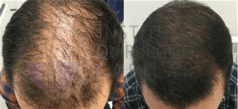 Trasplante capilar antes y después