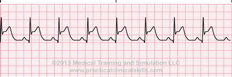 EKG Practice Drill