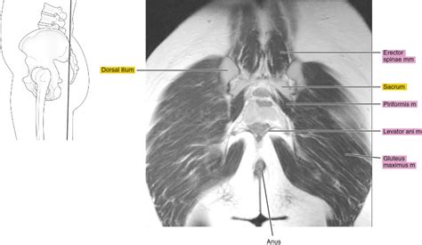 Mri Of The Female Pelvis Radiology Key
