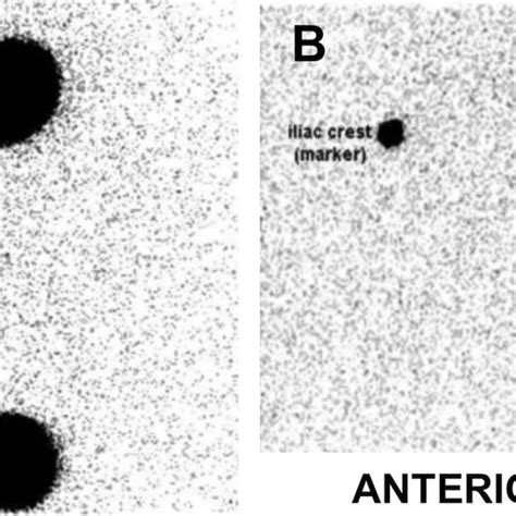Radioactive Iodine Scan A Thyroid Scintigraphy With Mci Of