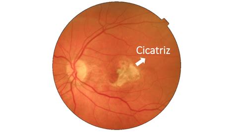 Degeneração Macular Instituto de Retina