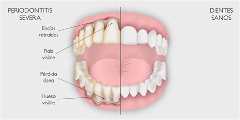 Assimilate interrupt Tól től enfermedades en las encias de los dientes