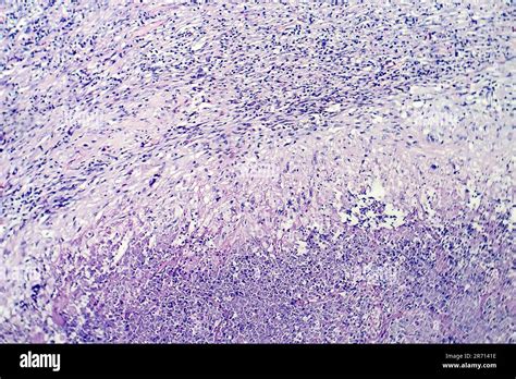 Histopathology Of Tuberculosis Light Micrograph Of Tuberculosis Lesion