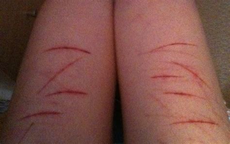 Self Harm Cuts Legs