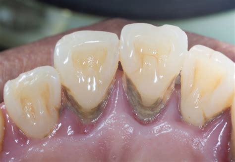 Qu Es Periodontitis Previene Esta Enfermedad Zigomat