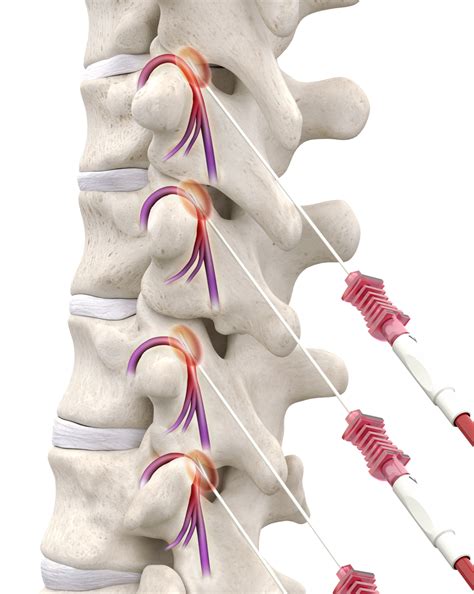 Lumbar Radiofrequency Ablation RFA For Pain Relief