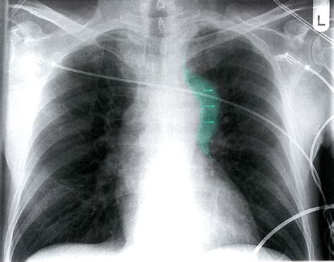 X Ray Images Of Aortic Tear