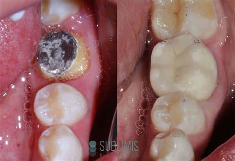 Coronas De Porcelana Precios Fundas Dentales En Argentina