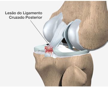 Dr Marcelo Tostes Les O Do Ligamento Cruzado Posterior