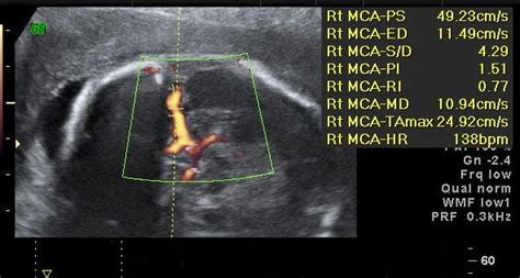 Doppler Fetalmed Medicina Fetal Em Curitiba