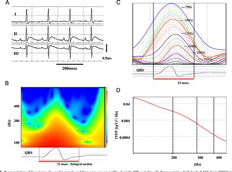 Figure 1 From Time Frequency Power Profile Of QRS Complex Obtained With