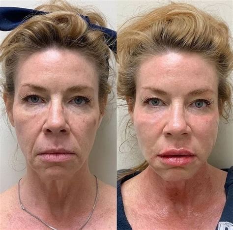 PDO Thread Lift Best Treatment To Reduce Jowls In Orange County