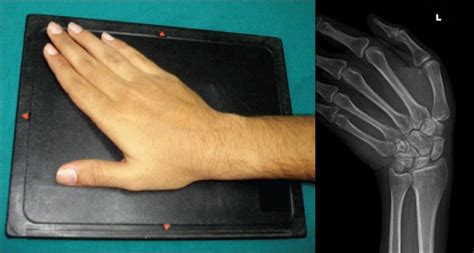 Ulnar Deviation