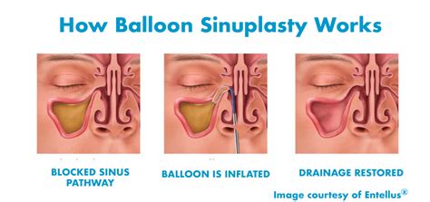 Balloon Sinuplasty The Midwest Sinus Center