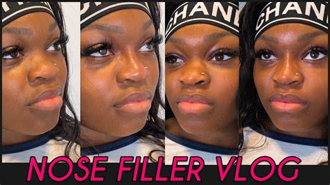 I Got Nose Filler Non Surgical Rhinoplasty Nose Surgery Black Girl