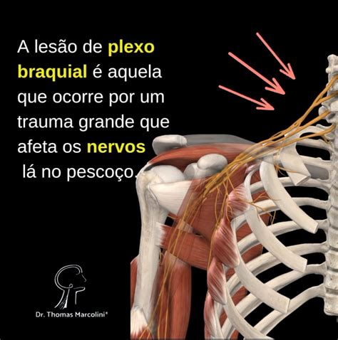 Causas De Les O Do Plexo Braquial Voc Sabe Quais S O