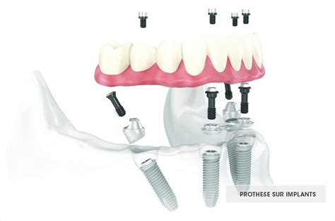 Implants Dentaires Saint Denis Centre Dentaire Elise