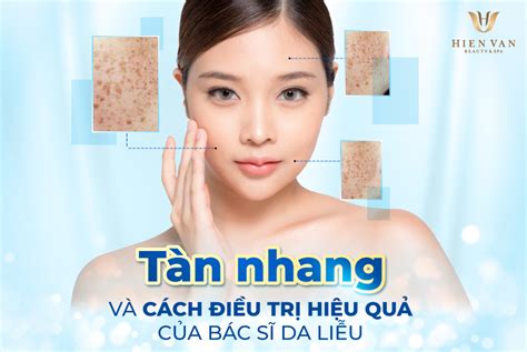 Tàn nhang dấu hiệu nhận biết cách trị tàn nhang hiệu quả đơn giản nhất