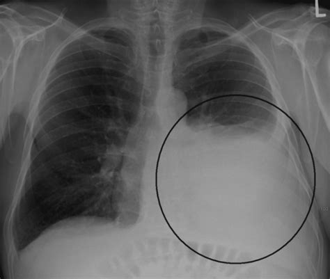 OSCE Chest X Ray Interpretation Flashcards Quizlet