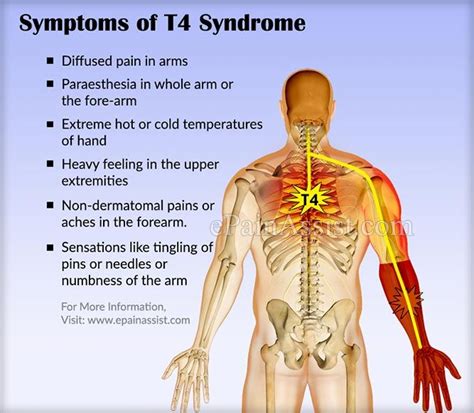 Bilateral Arm Pain Numbness That Wont Go Away T Syndrome Is More